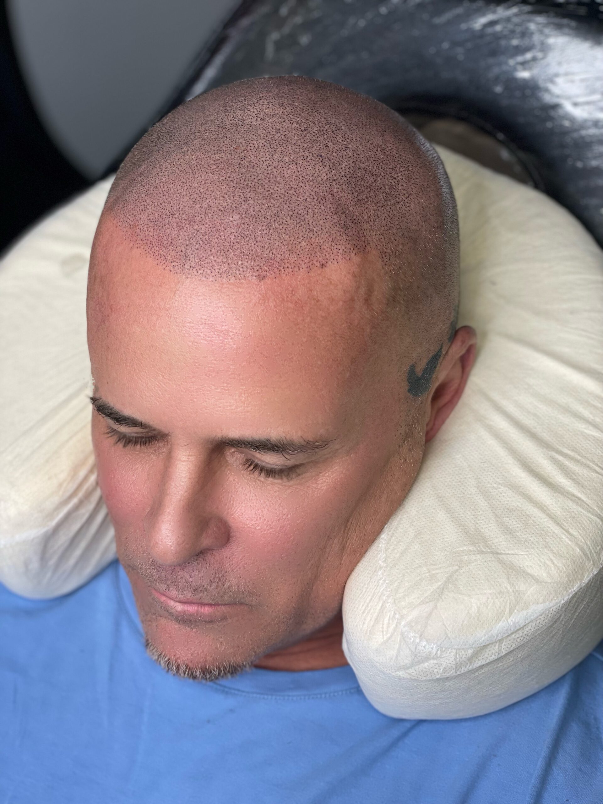 Scalp Micropigmentation Carlsbad - Scalp Micro M3