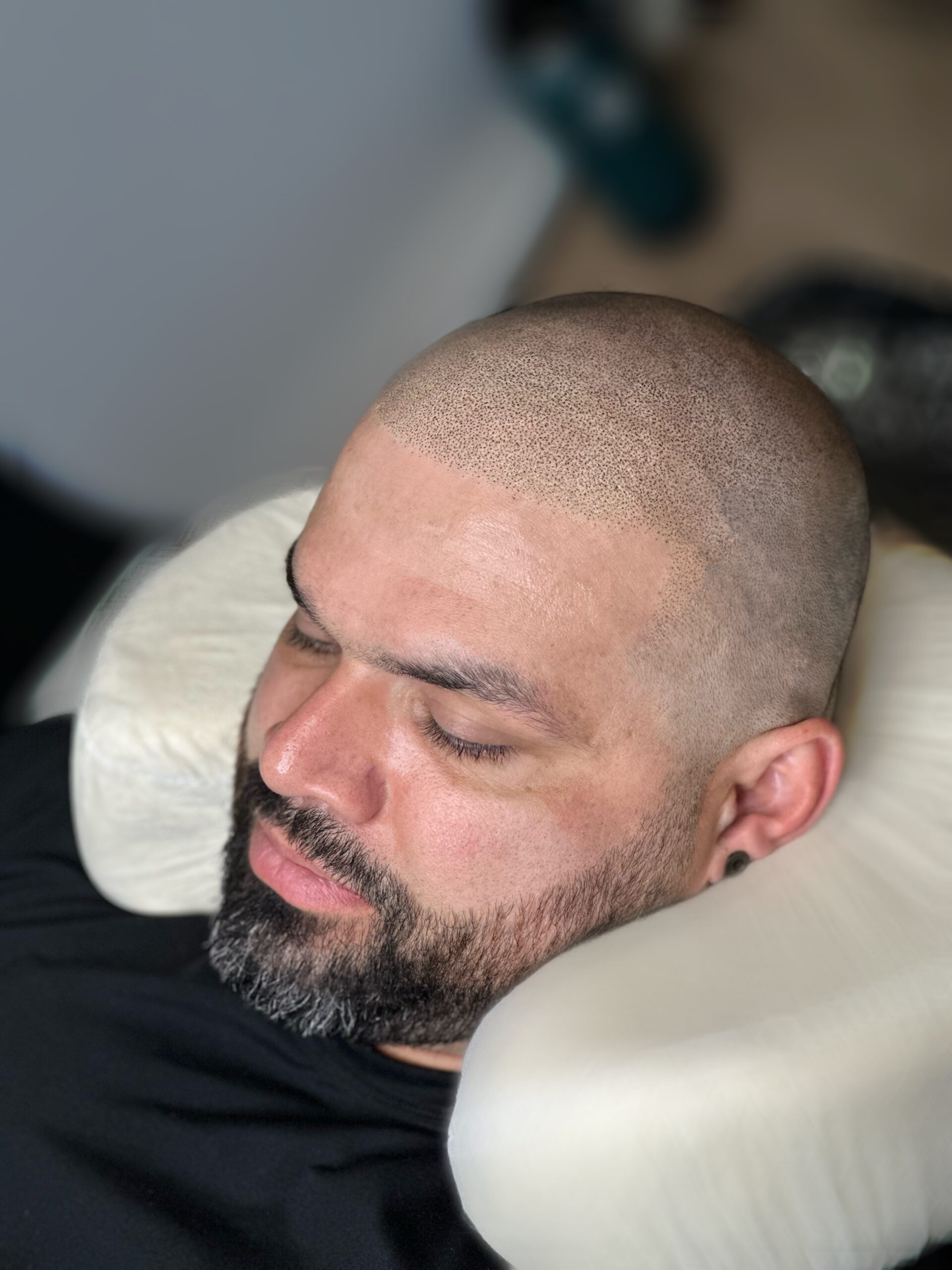 Scalp Micropigmentation Carlsbad - Scalp Micro M3